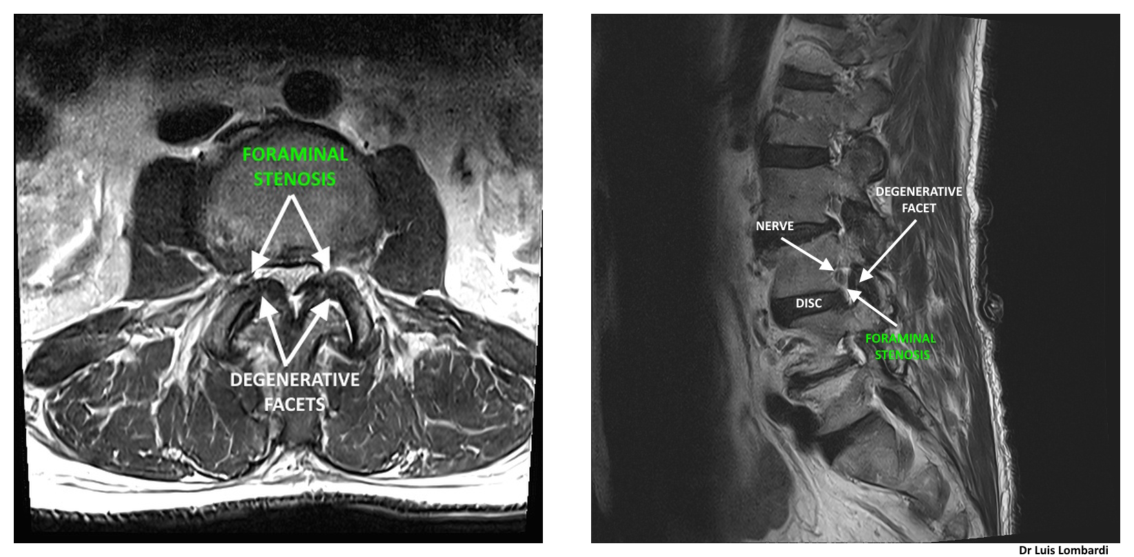 Degenerative Foraminal Stenosis: Key Surgical Planning Insights ...
